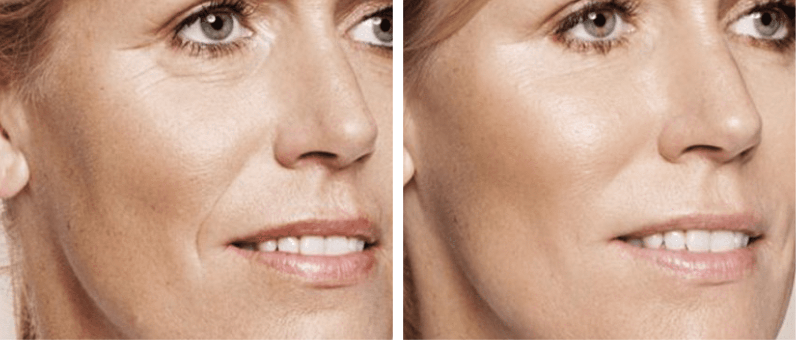 Cheek Fillers in Cypress, TX | Balle Bliss