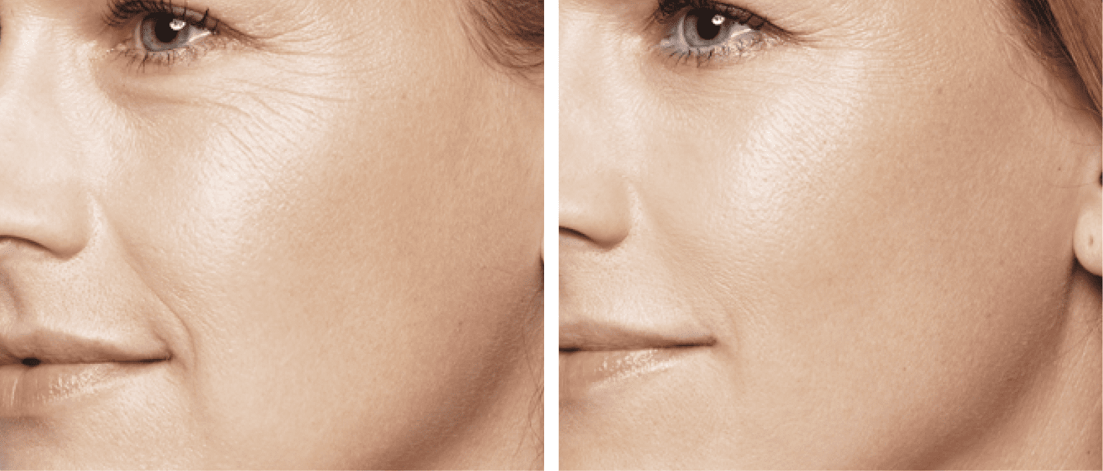 Cheek Fillers in Cypress, TX | Balle Bliss